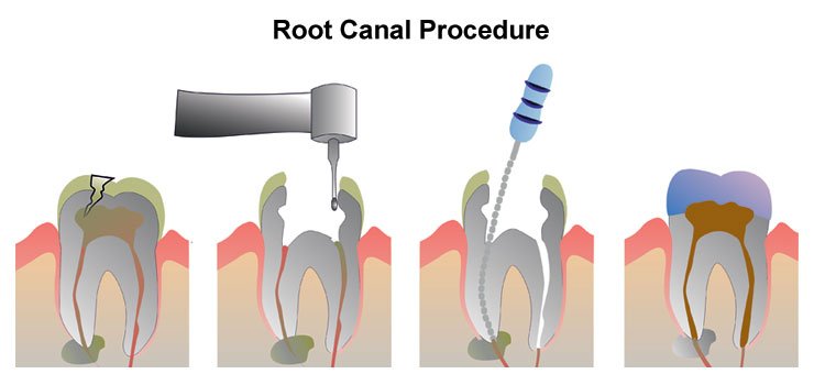 Costa Rica Root Canal Procedure | Advance Dental